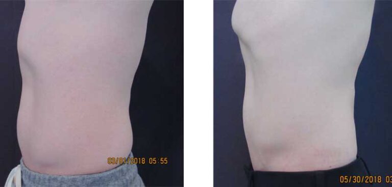 Non-Invasive Body Fat Removal in Baldwin Park & Winter Park, FL
